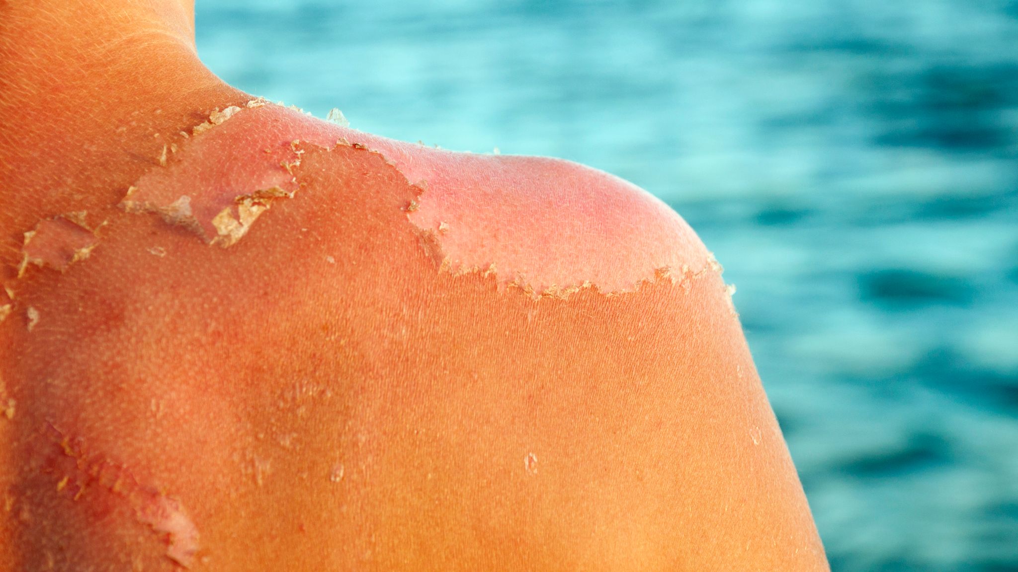 Sunburn isn't just red skin - here's what's happening underneath the ...