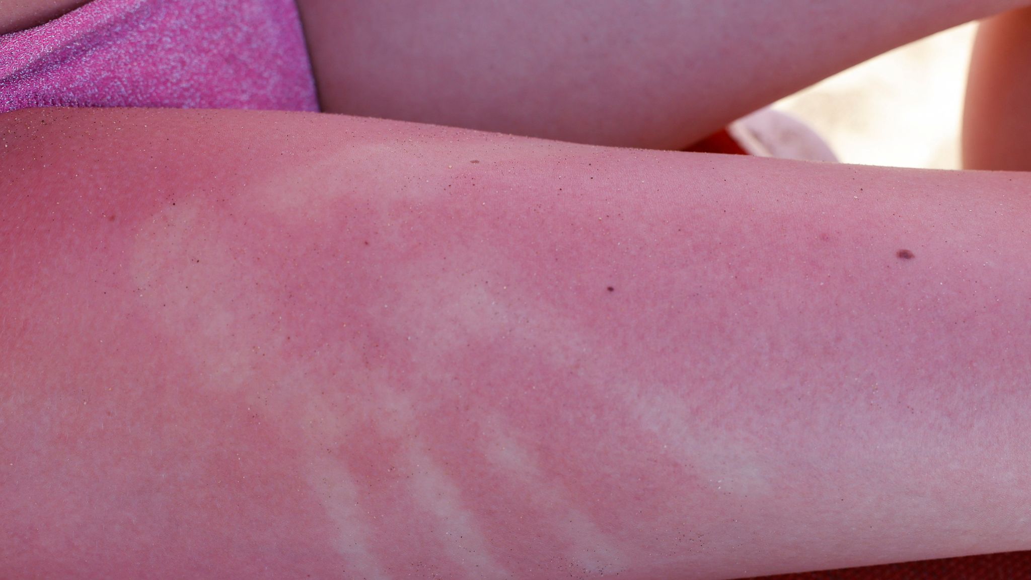 Sunburn isn't just red skin - here's what's happening underneath the ...
