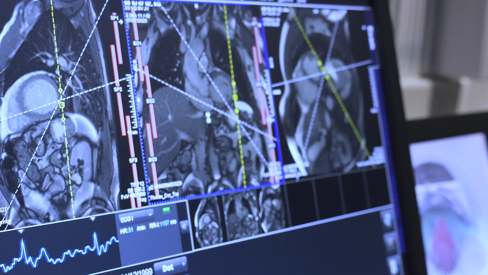 World's biggest human imaging project reaches new milestone after ...