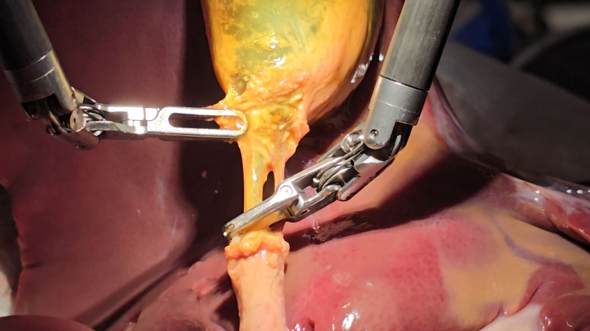 Robot performs realistic gallbladder surgery 'with 100% accuracy' | US ...