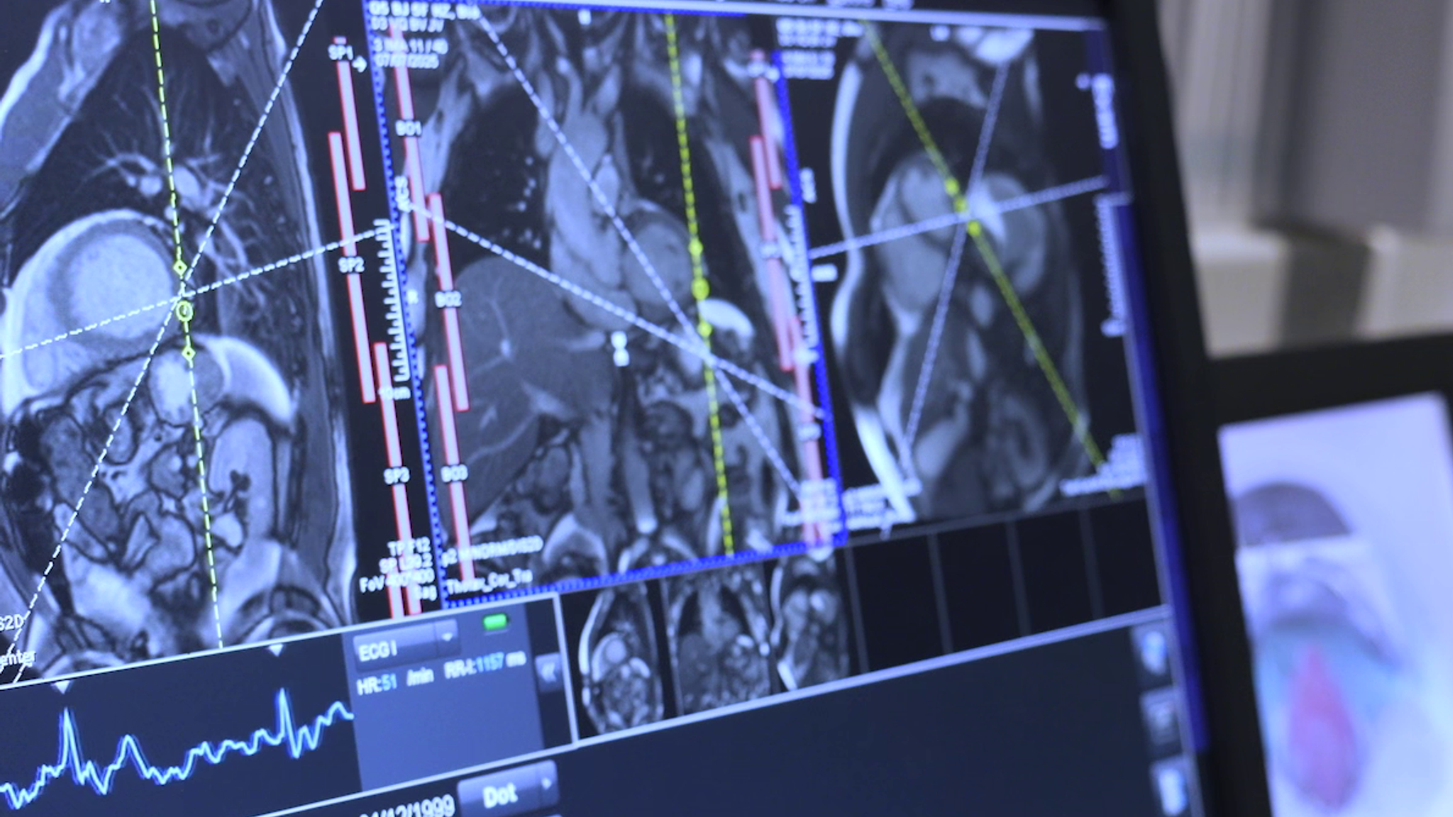 World's biggest human imaging project reaches new milestone after ...