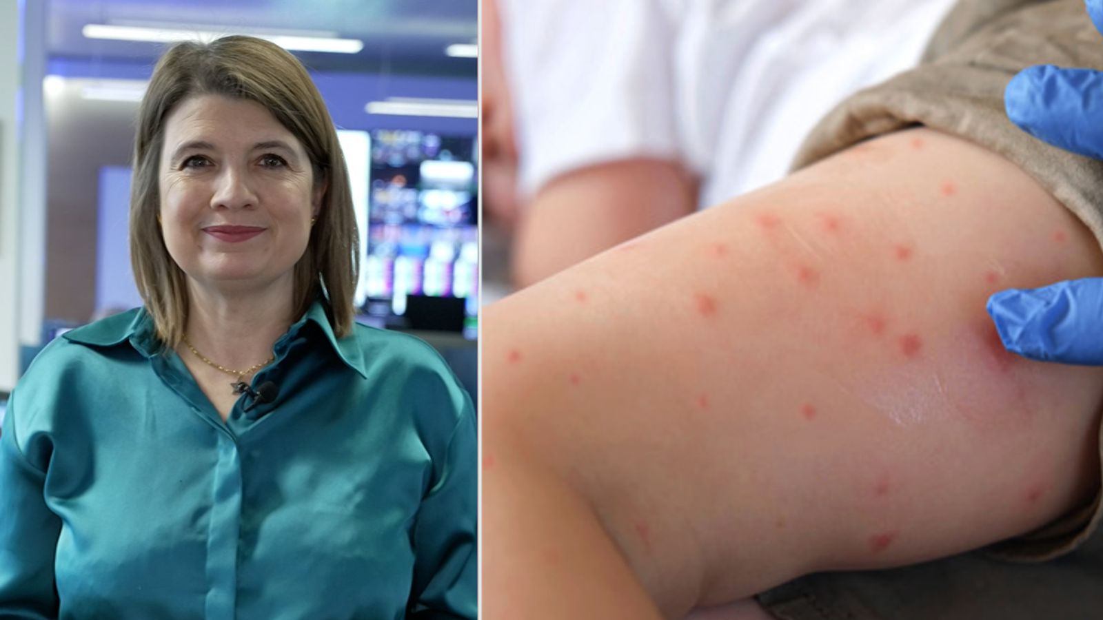 How serious is measles and how worried should we be? | UK News | Sky News