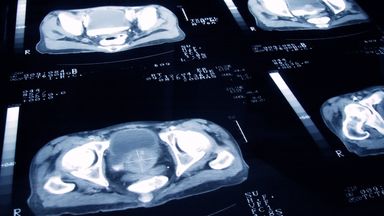 'Cutting-edge' prostate cancer treatment to be rolled out by NHS from ...